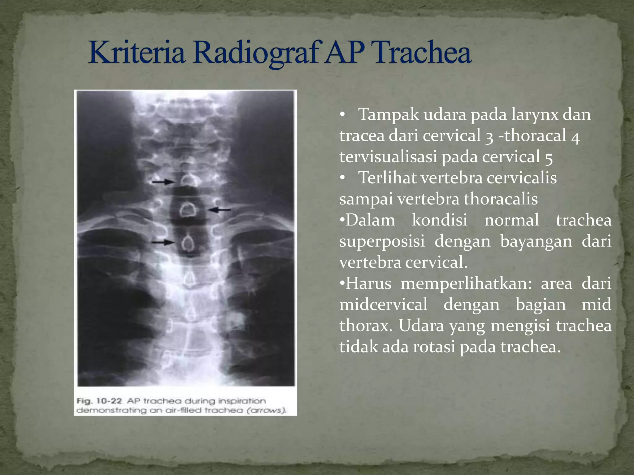 Teknik Pemeriksaan Radiografi Faring laring trakhea | PPTX