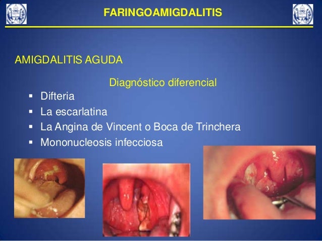 Faringoamigdalitis Agudas y Cronicas