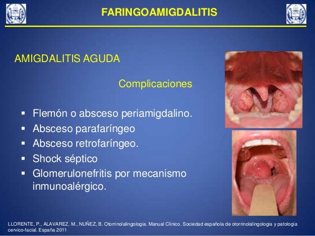 Faringoamigdalitis Aguda: Síntomas Y Tratamiento – RKIF