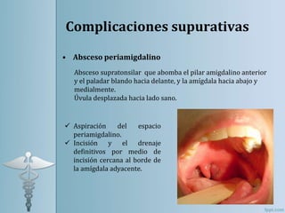 Faringoamigdalitis | PPTX | Ear, Nose and Throat Conditions | Diseases ...