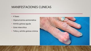 Farmacos para el tratamiento de la gota | PPTX