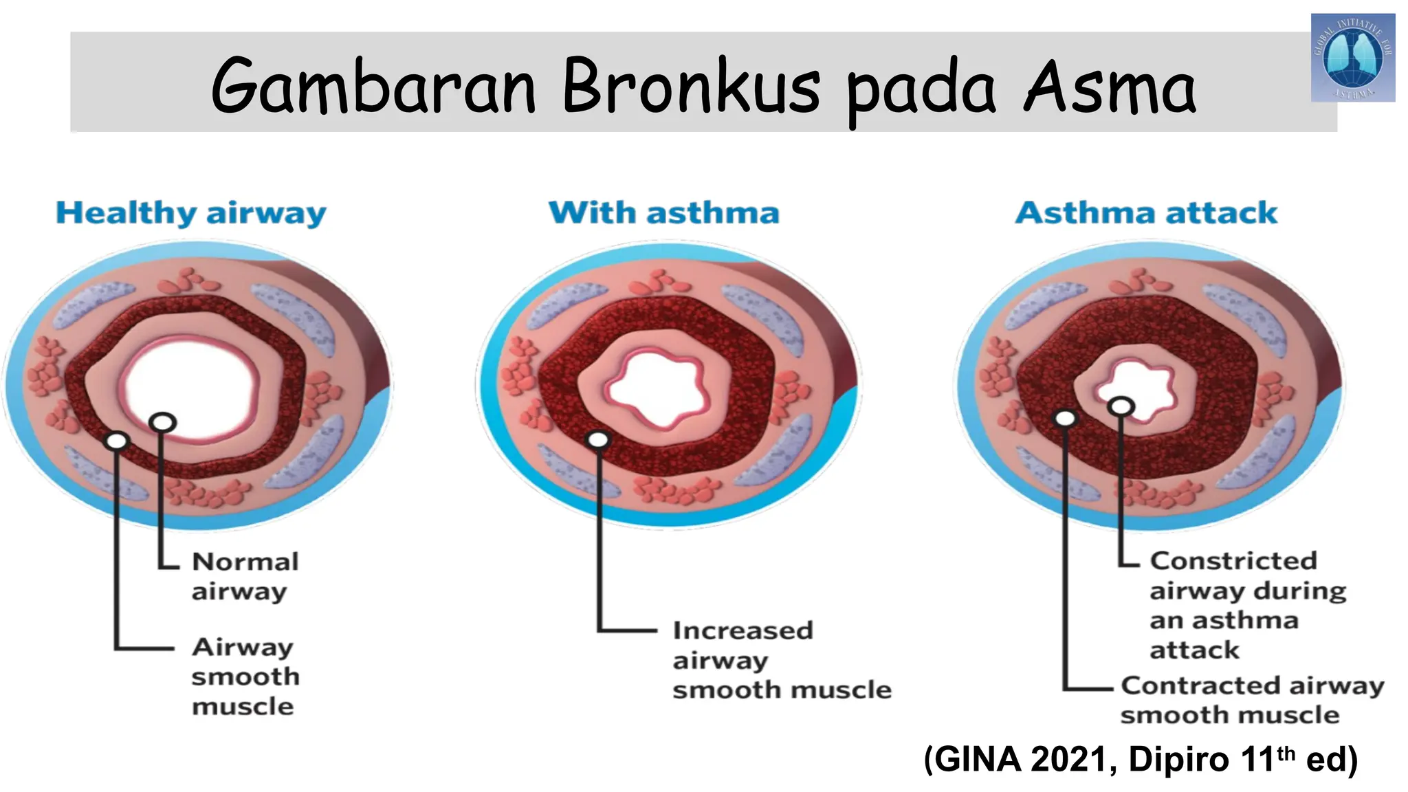 zzzzzzzzzzzzzzzzz-Farmakoterapi Asma.pptx