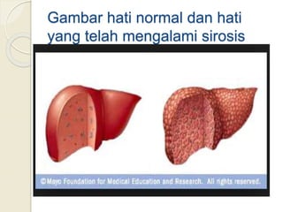 Farmakoterapi penyakit hati | PPTX