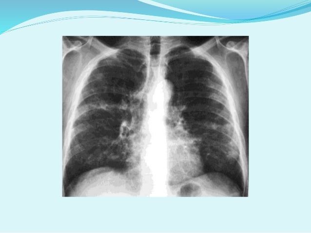 Farmer’s lung