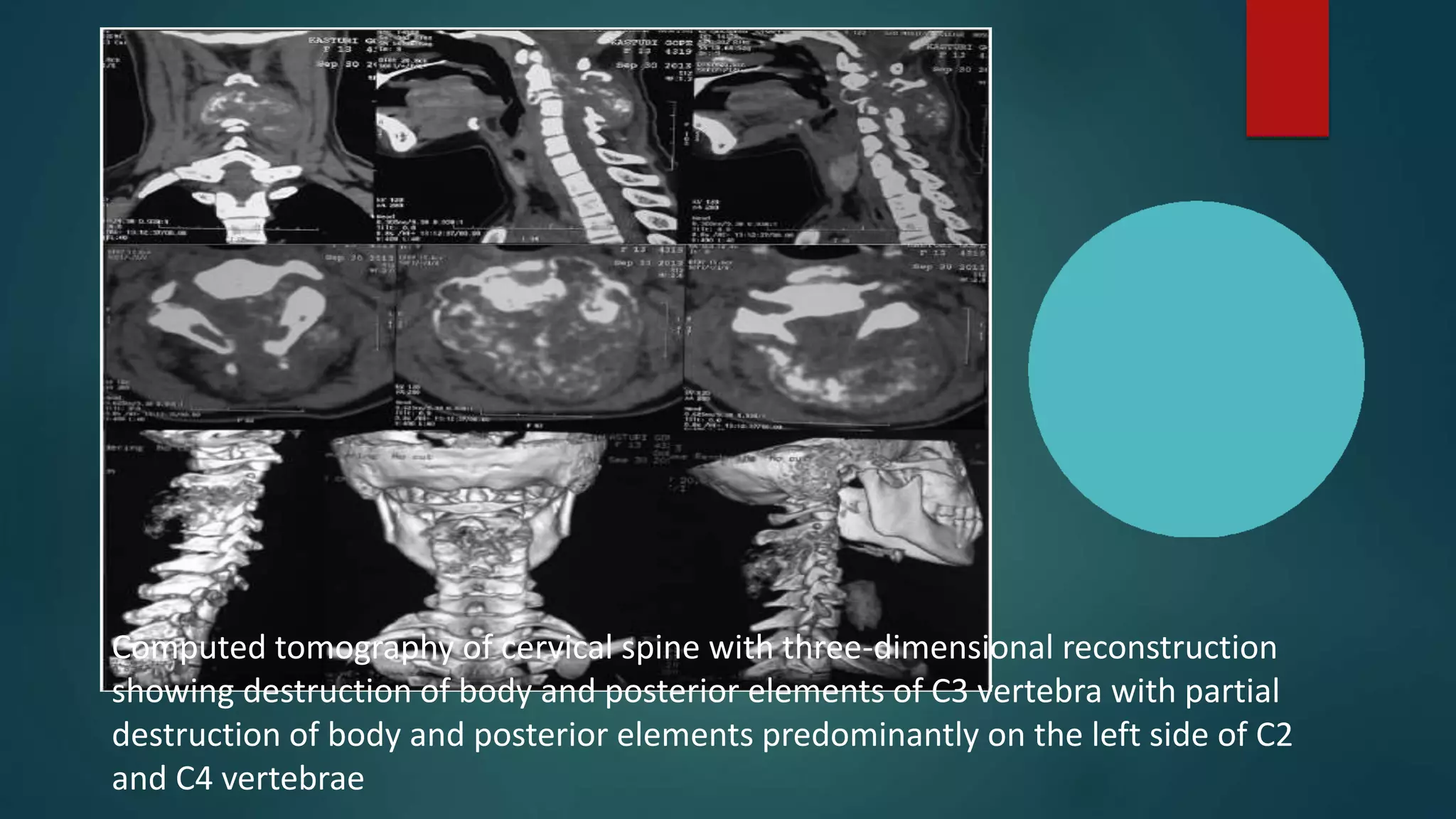 Aneurysmal Bone Cyst | PPTX