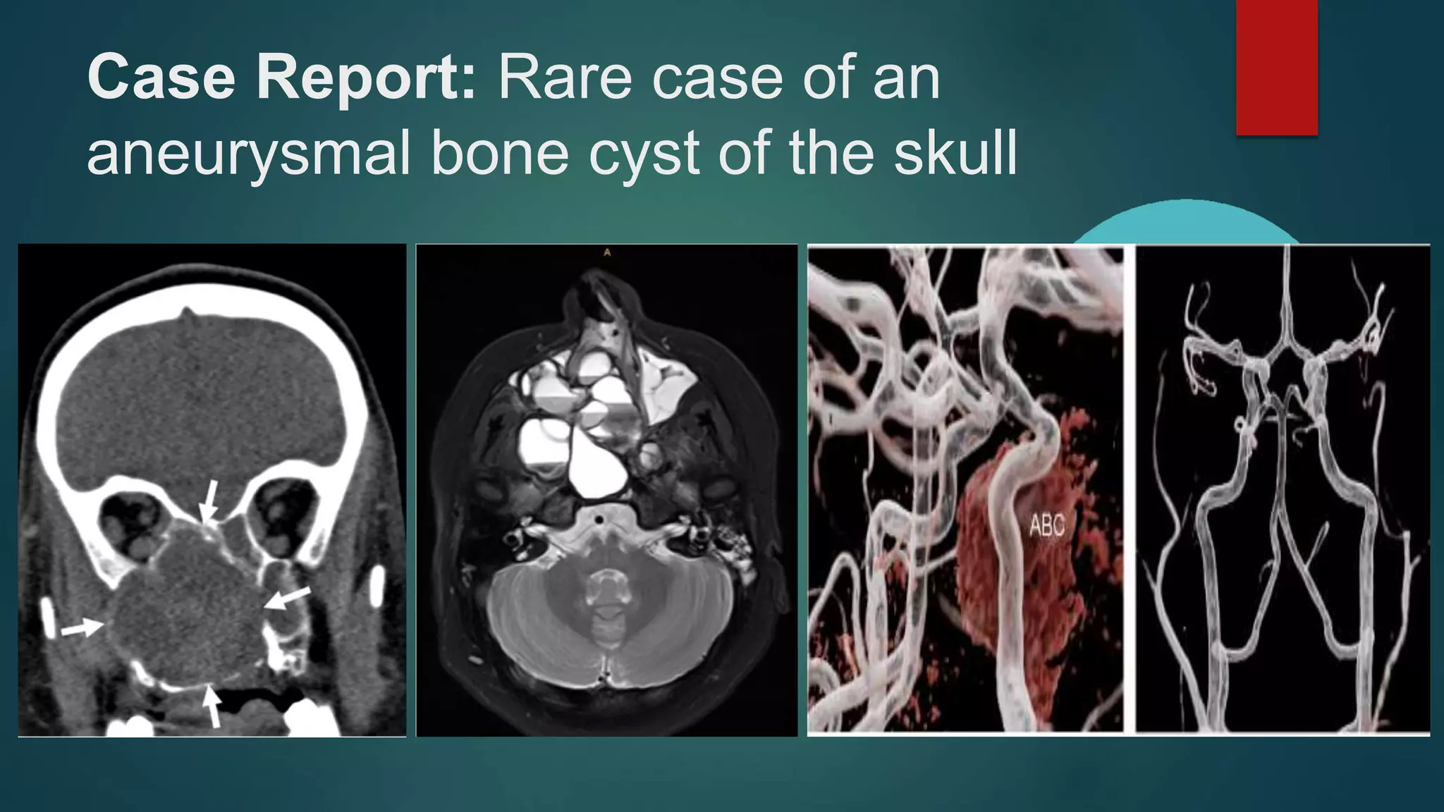 Aneurysmal Bone Cyst | PPTX