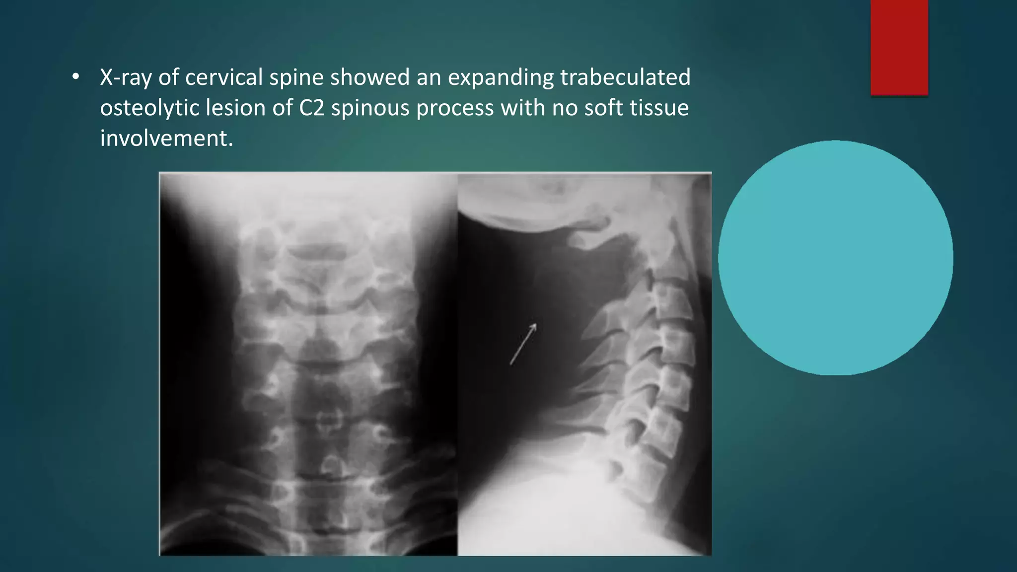 Aneurysmal Bone Cyst | PPTX