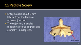 C2 Pedicle And Lamina