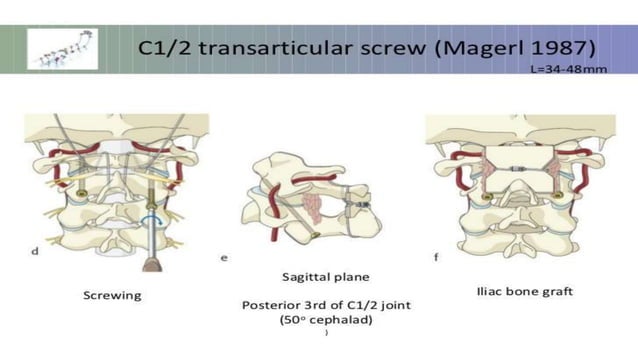 Cervical Fusion: C1-C2 Fusion