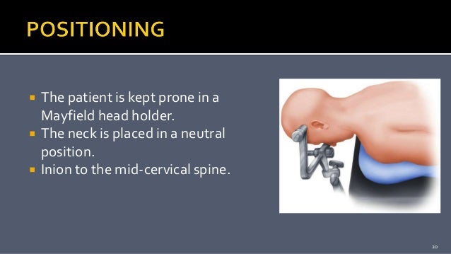 Cervical Fusion: C1-C2 Fusion