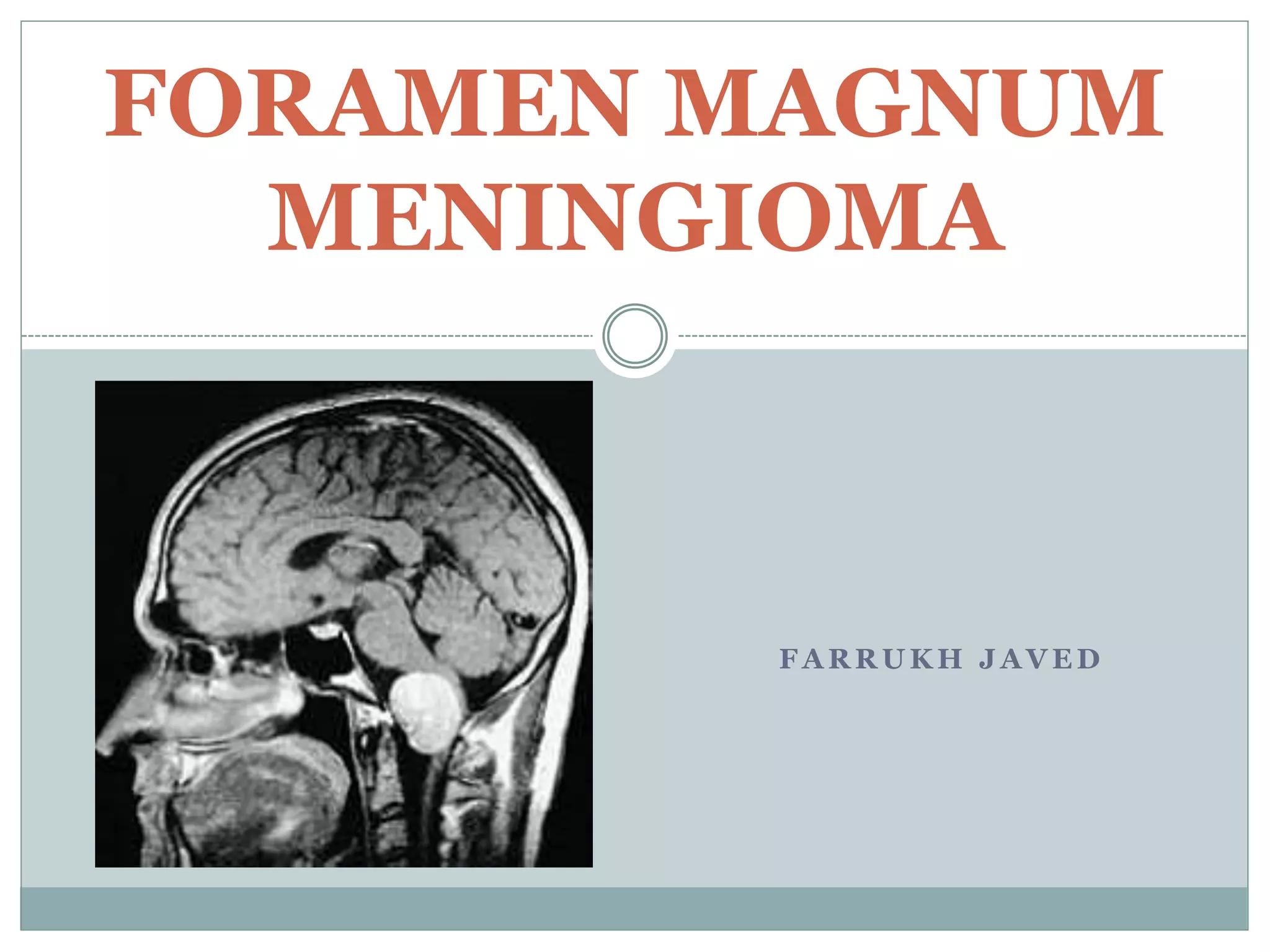 Foramen Magnum Meningioma | PPTX