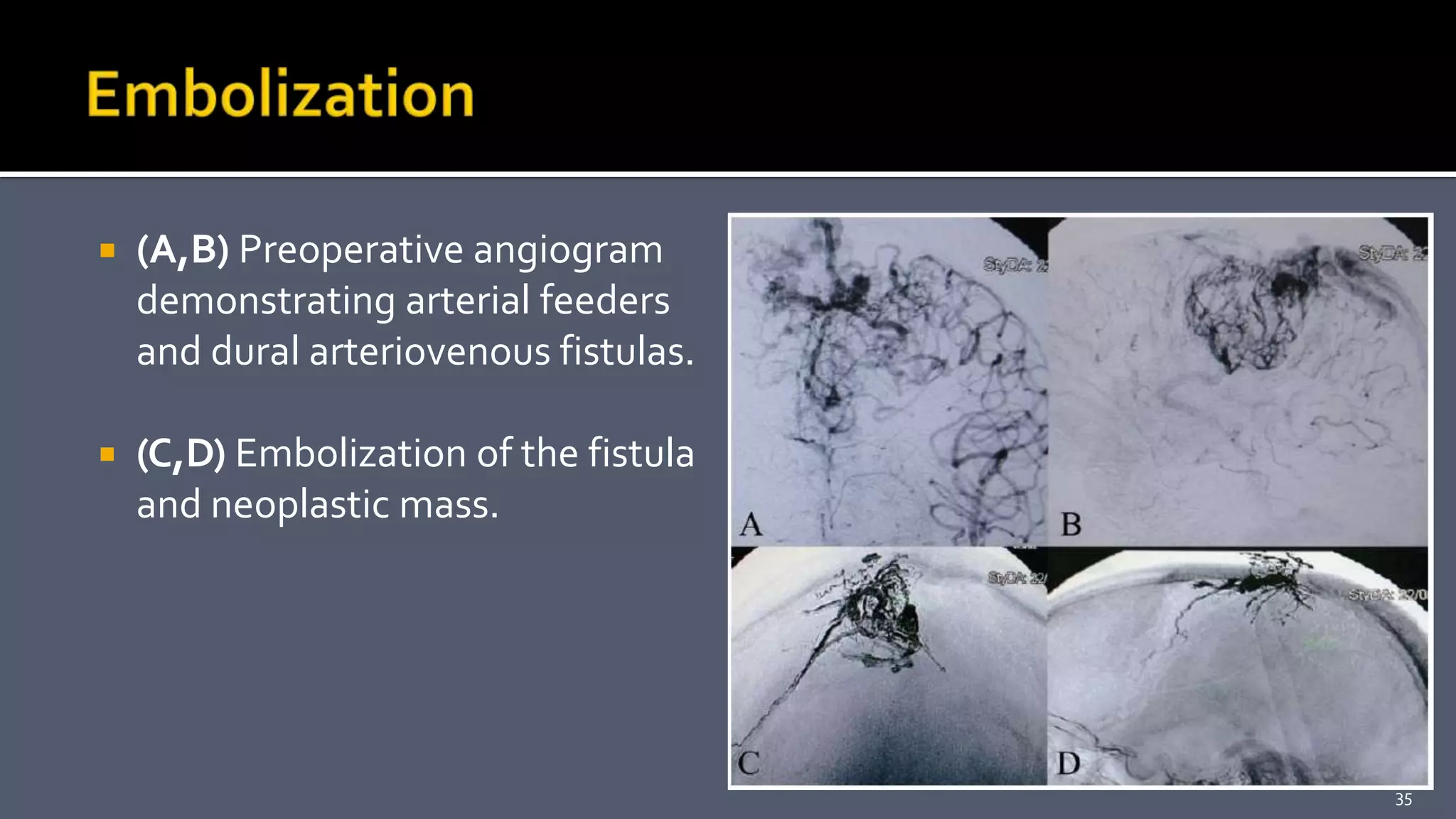 Parasagittal Meningioma | PPTX