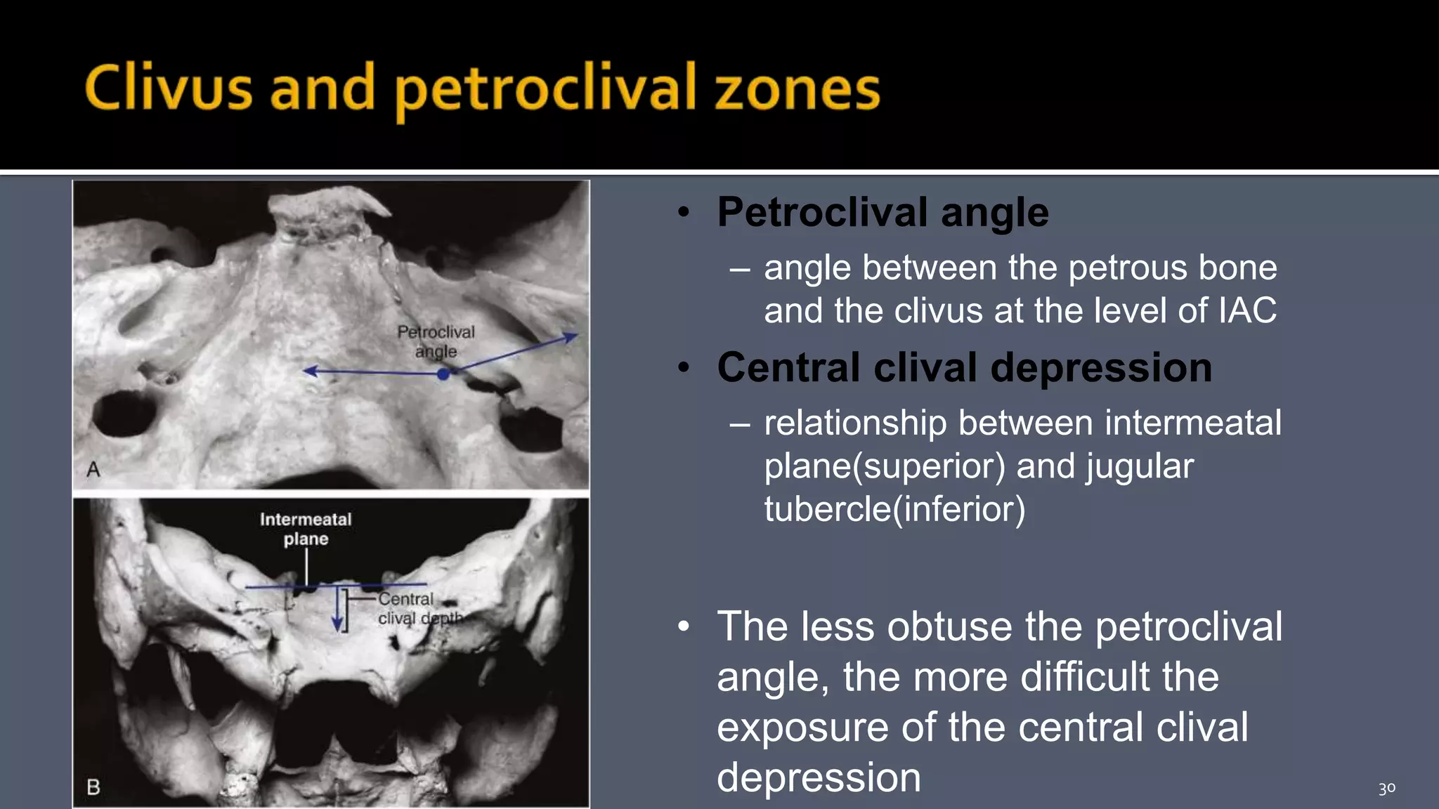 Petroclival Meningioma | PPTX