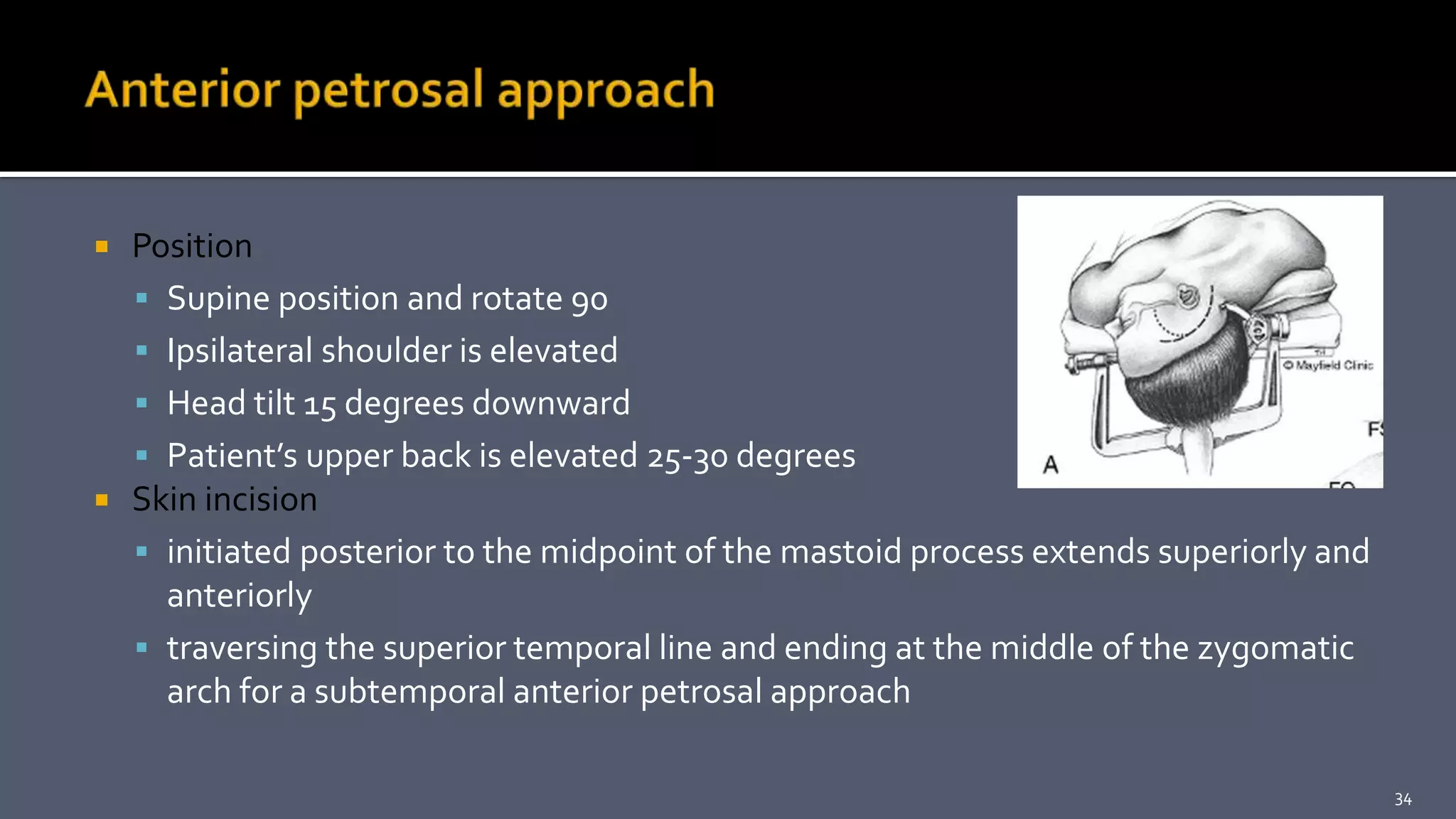 Petroclival Meningioma | PPTX