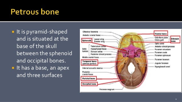 Petroclival Meningioma