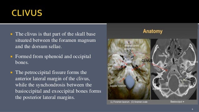 Petroclival Meningioma
