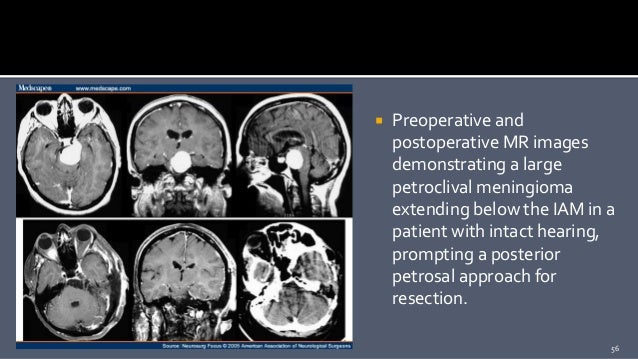 Petroclival Meningioma