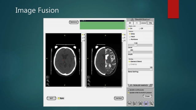 Stereotaxy Brain | PPTX | Brain and Nervous System Disorders | Diseases ...