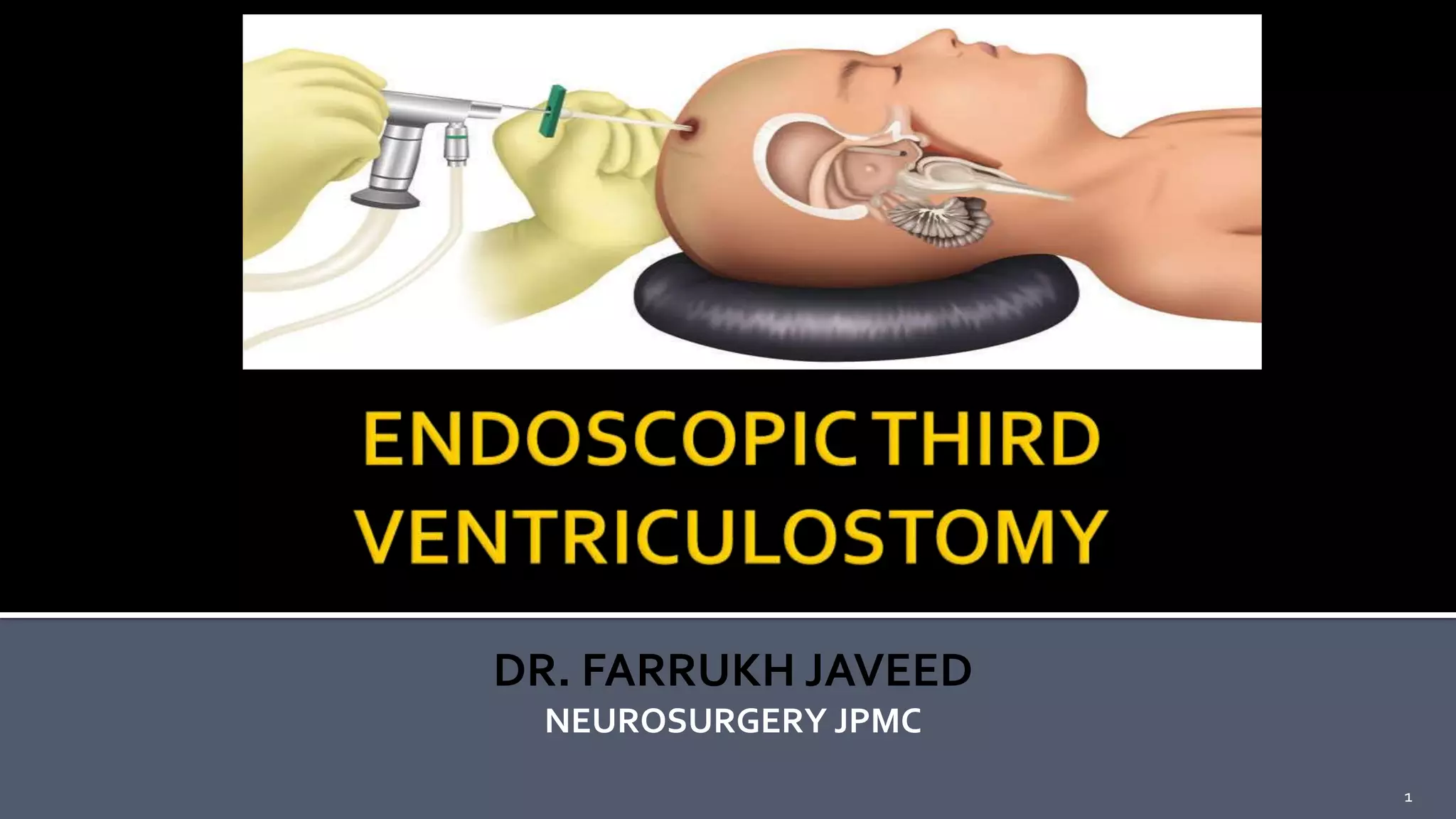 Endoscopic Third Ventriculostomy Ppt