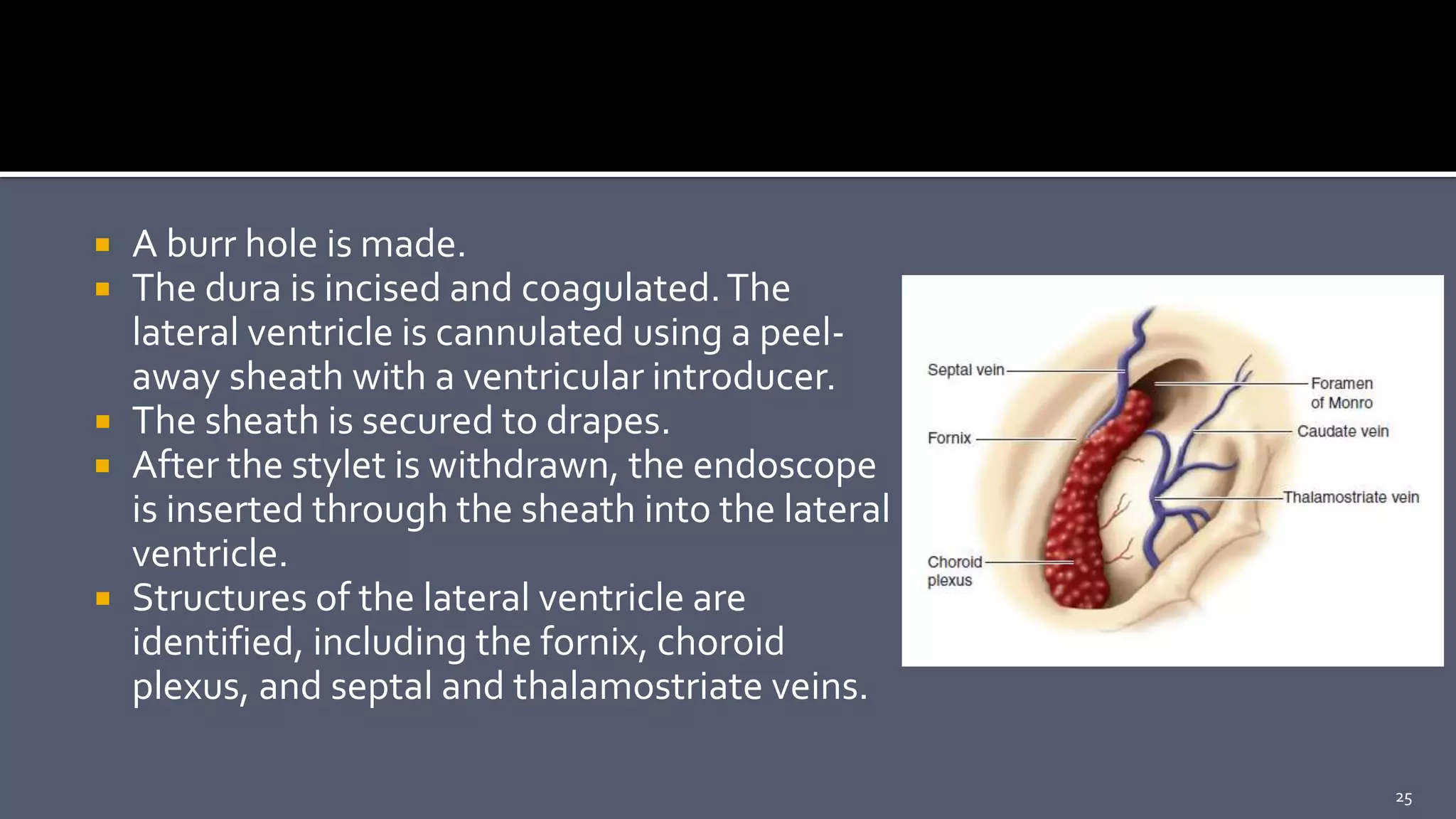 Endoscopic Third Ventriculostomy | PPTX
