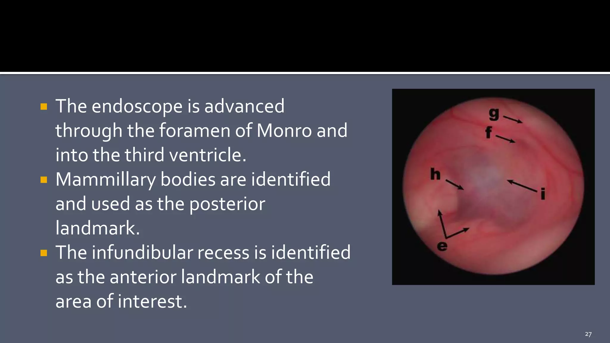 Endoscopic Third Ventriculostomy | PPTX