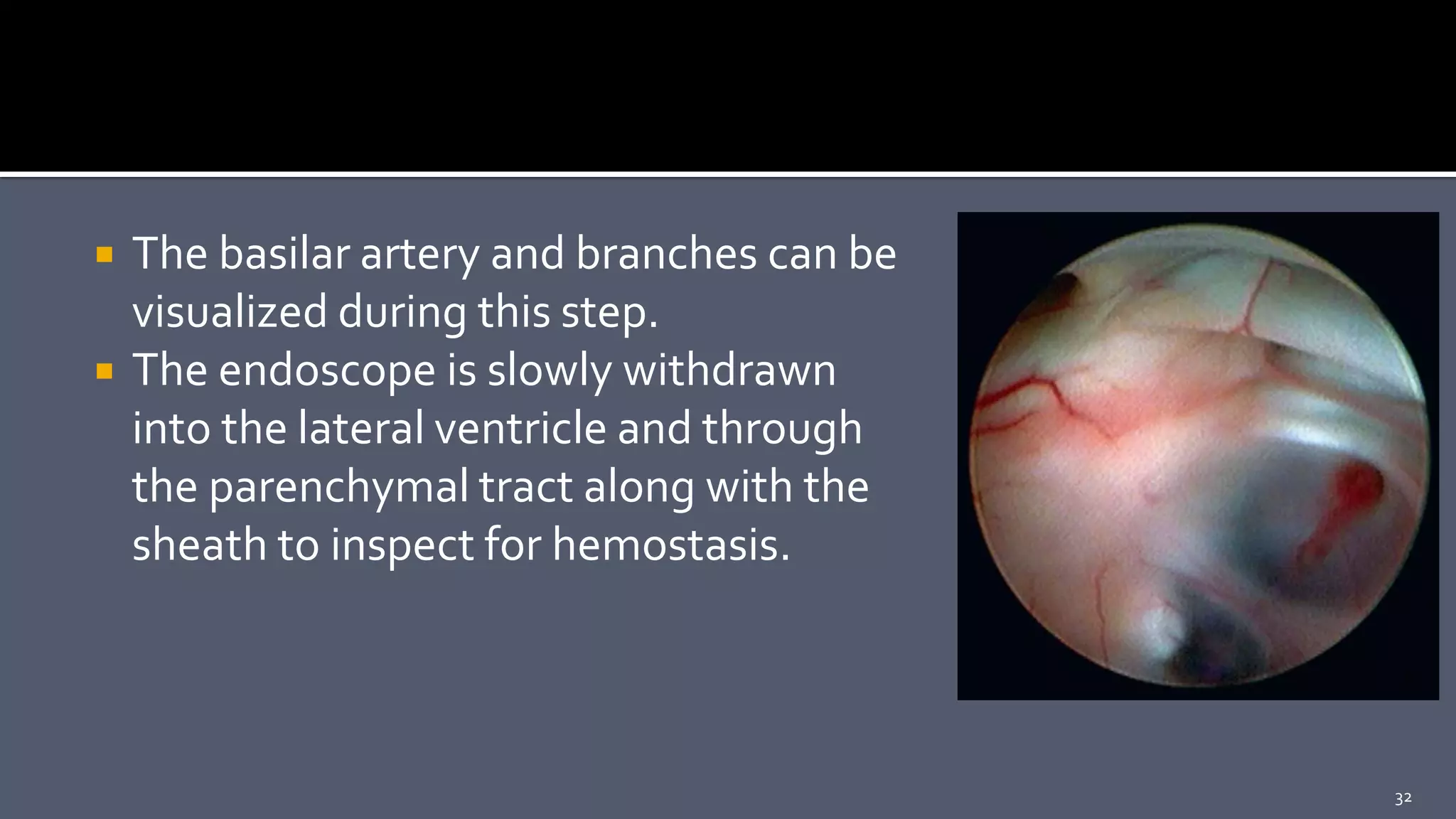 Endoscopic Third Ventriculostomy | PPTX
