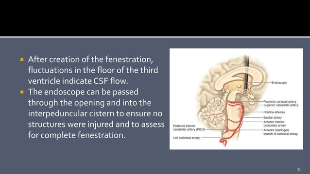 Endoscopic Third Ventriculostomy