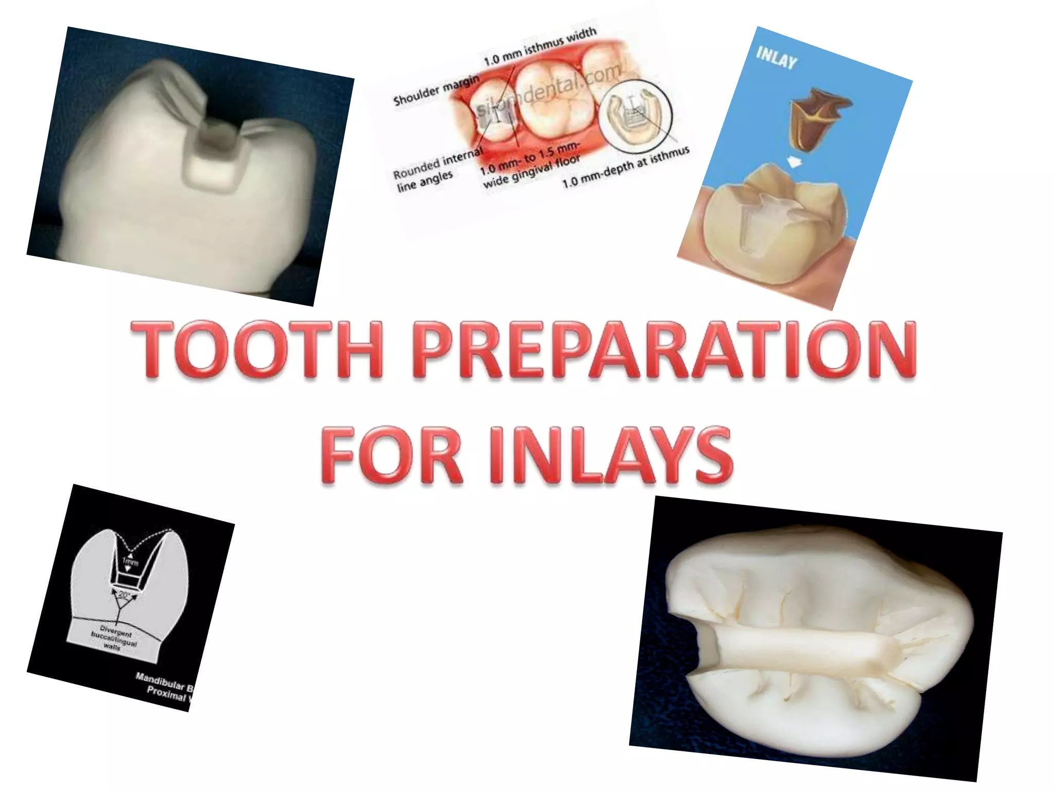 Inlays and Onlays | PPTX