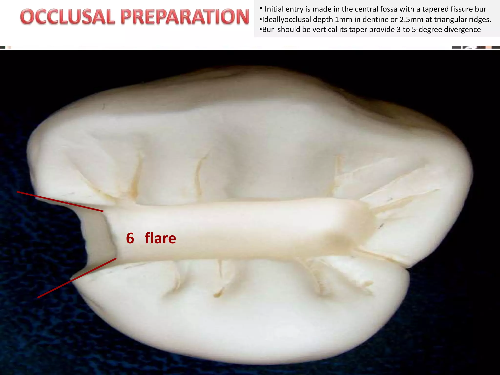 Inlays and Onlays | PPTX