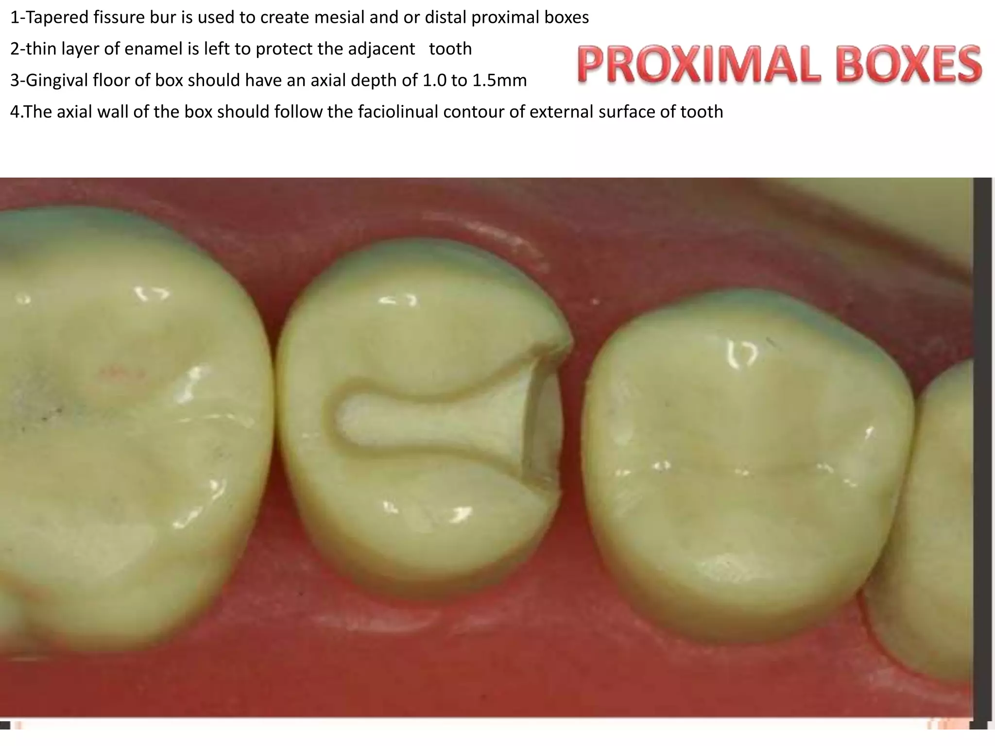 Inlays and Onlays | PPTX