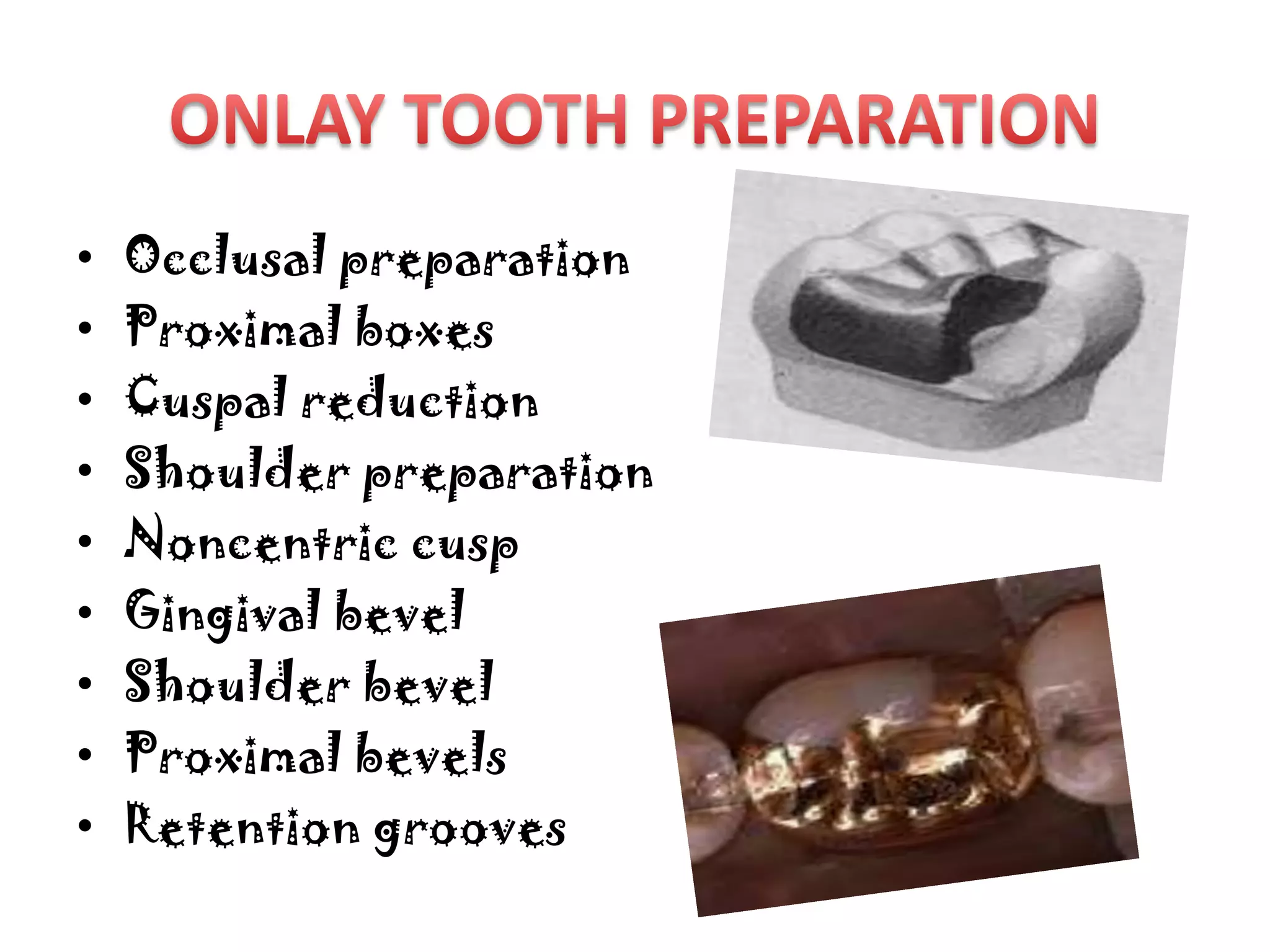 Inlays and Onlays | PPTX