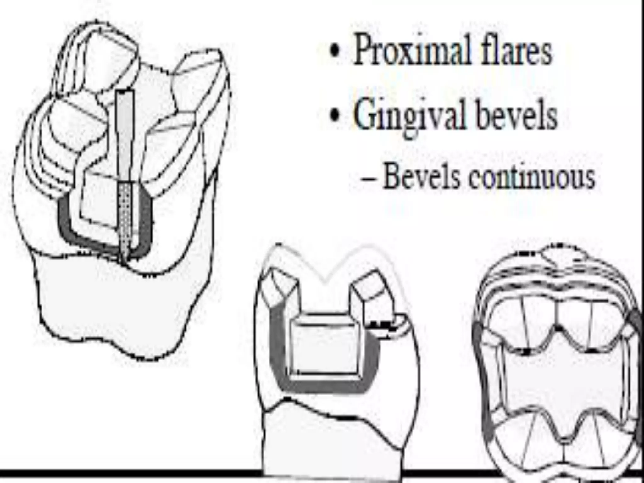 Inlays and Onlays | PPTX