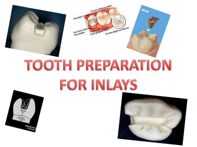 Inlays and Onlays | PPTX