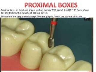Inlays and Onlays | PPTX