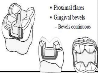 Inlays and Onlays | PPTX