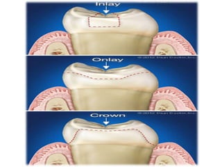 Inlays and Onlays | PPTX