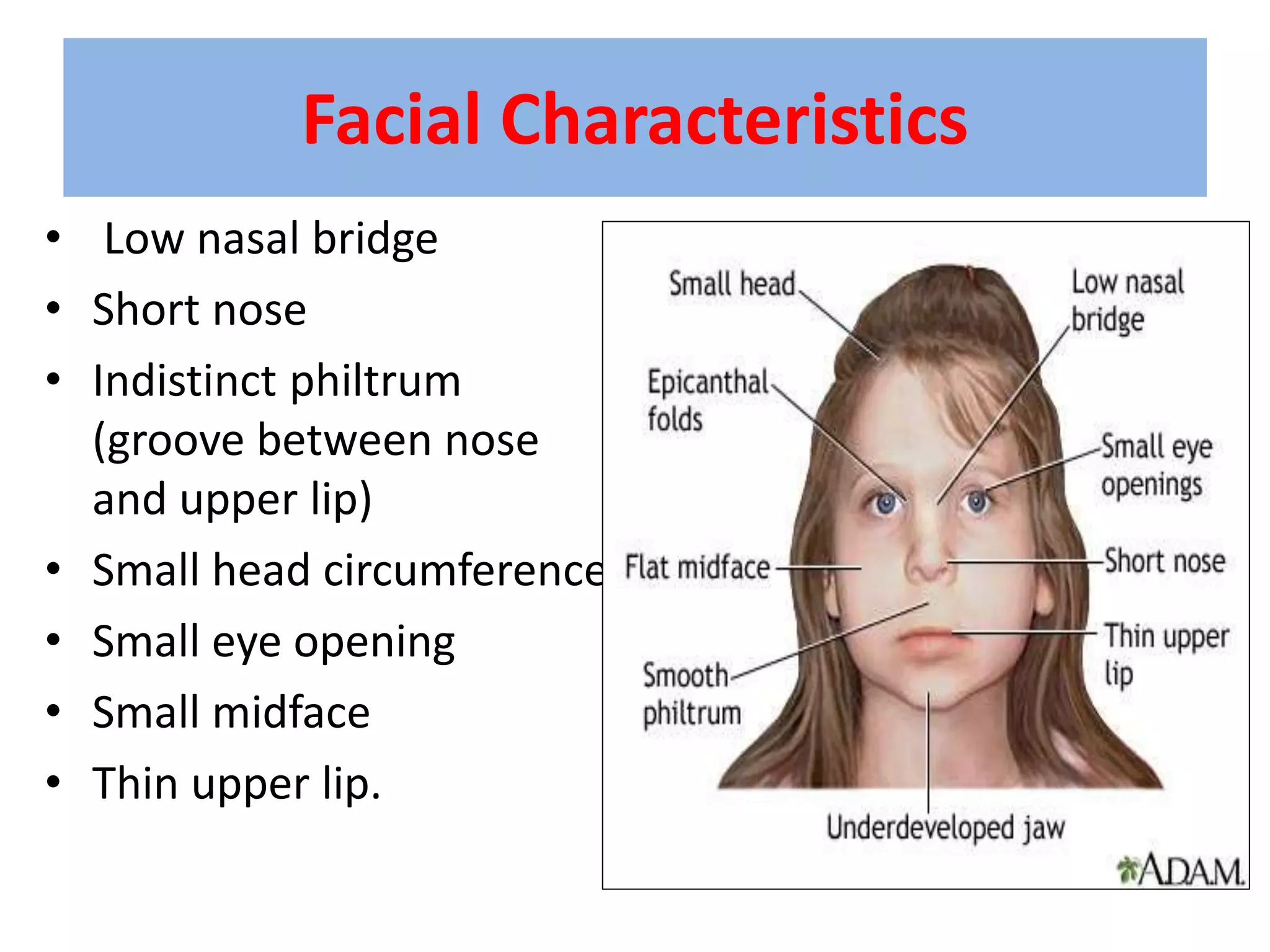FETAL ALCOHOL SYNDROME(FAS) | PPTX