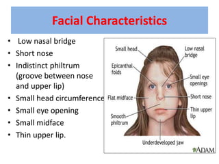 FETAL ALCOHOL SYNDROME(FAS) | PPTX