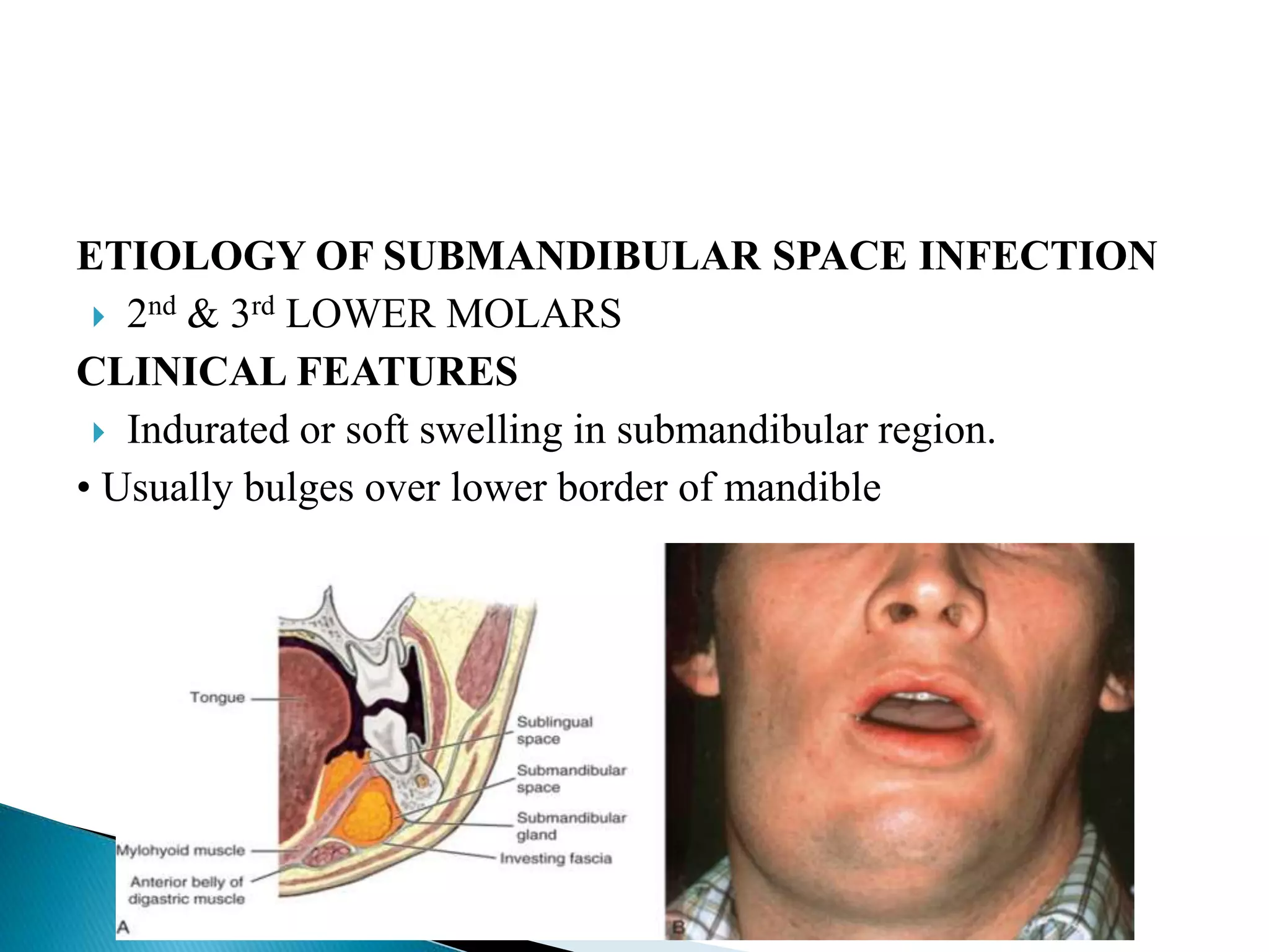 Fascial space infection | PPTX