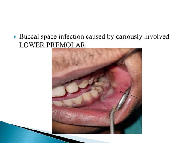Fascial space infection | PPTX