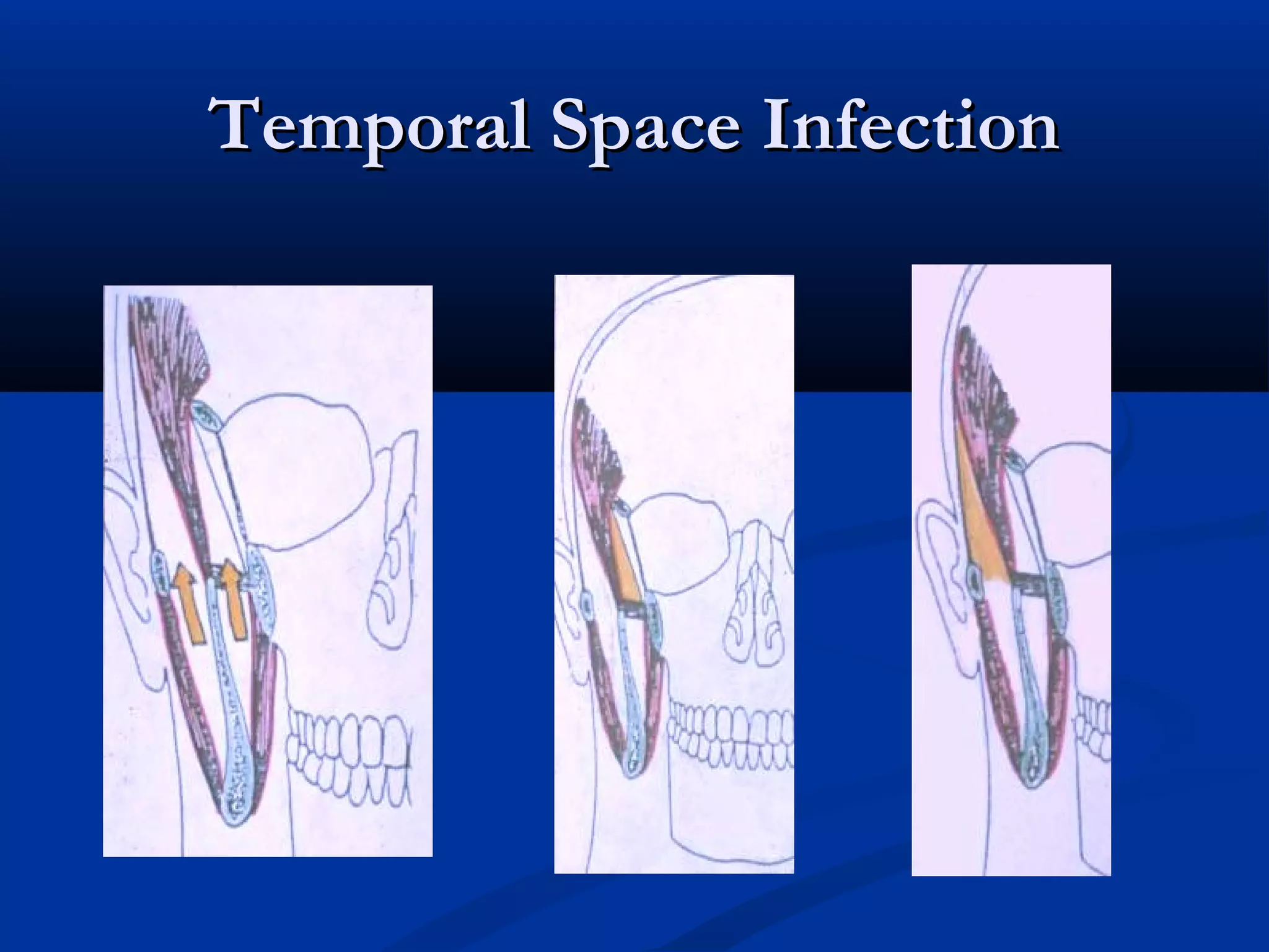 Fascial space & infections | PPT