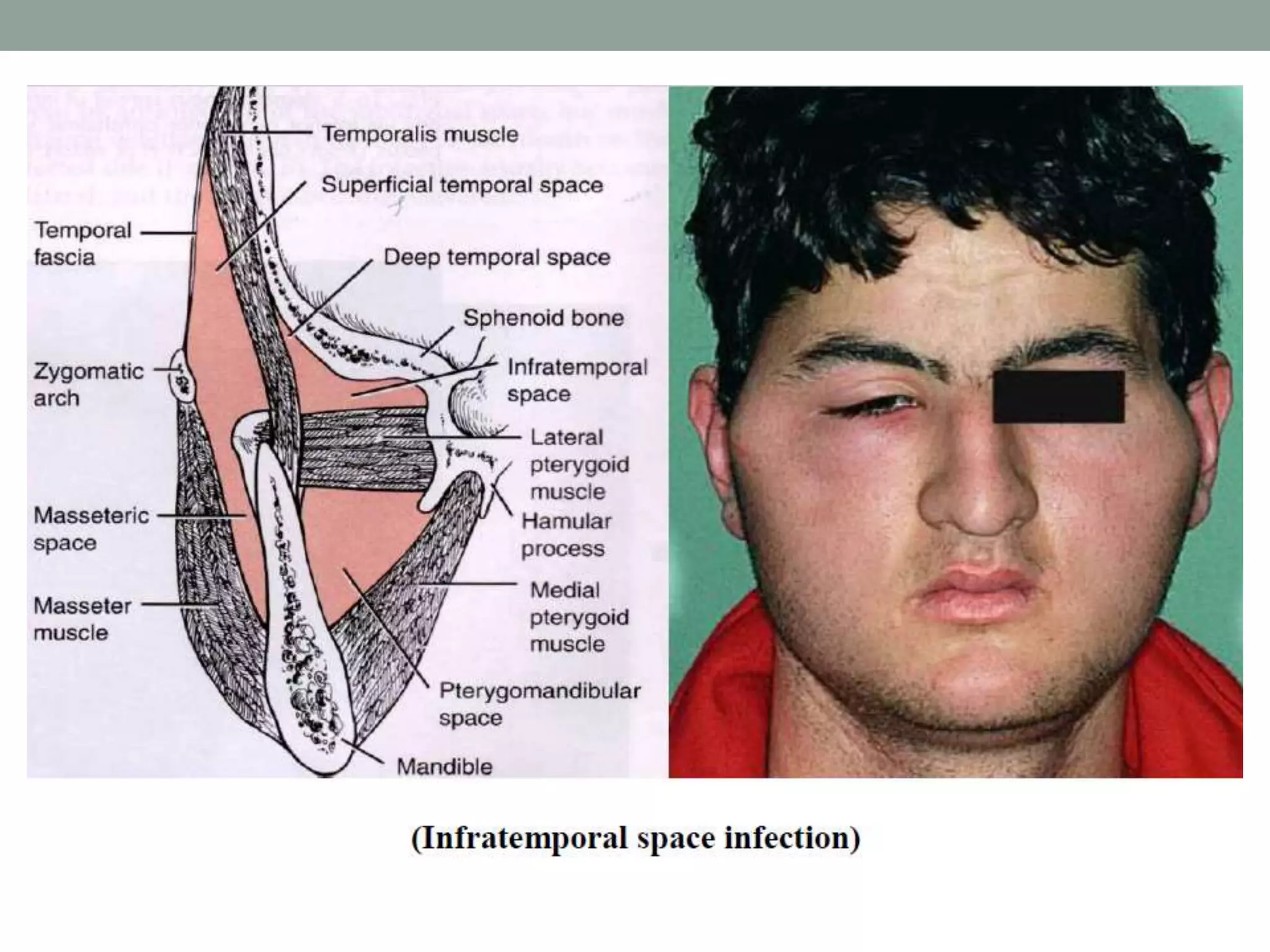 Fascial spaces.pptx | Ear, Nose and Throat Conditions | Diseases and ...