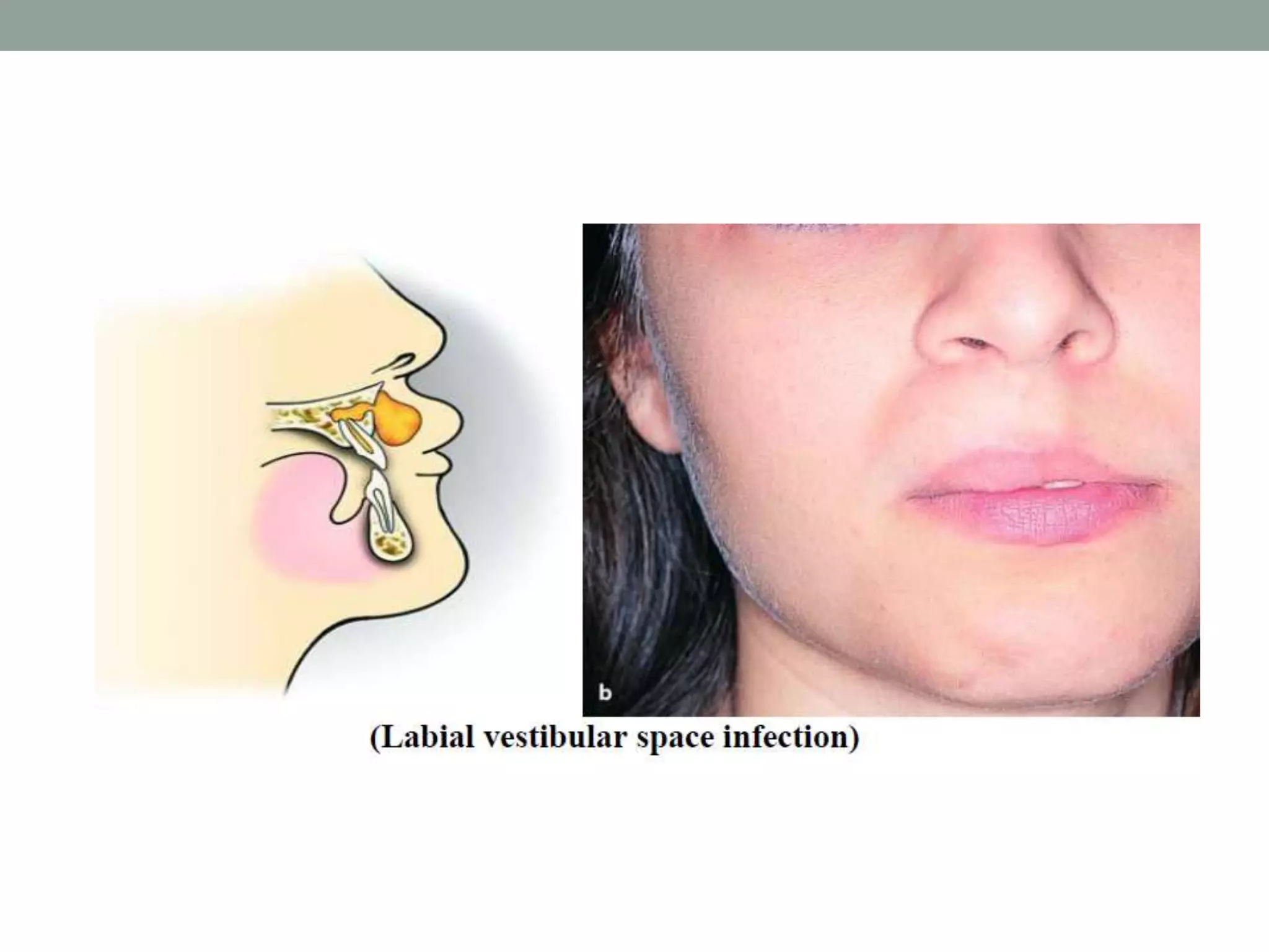 Fascial spaces.pptx | Ear, Nose and Throat Conditions | Diseases and ...