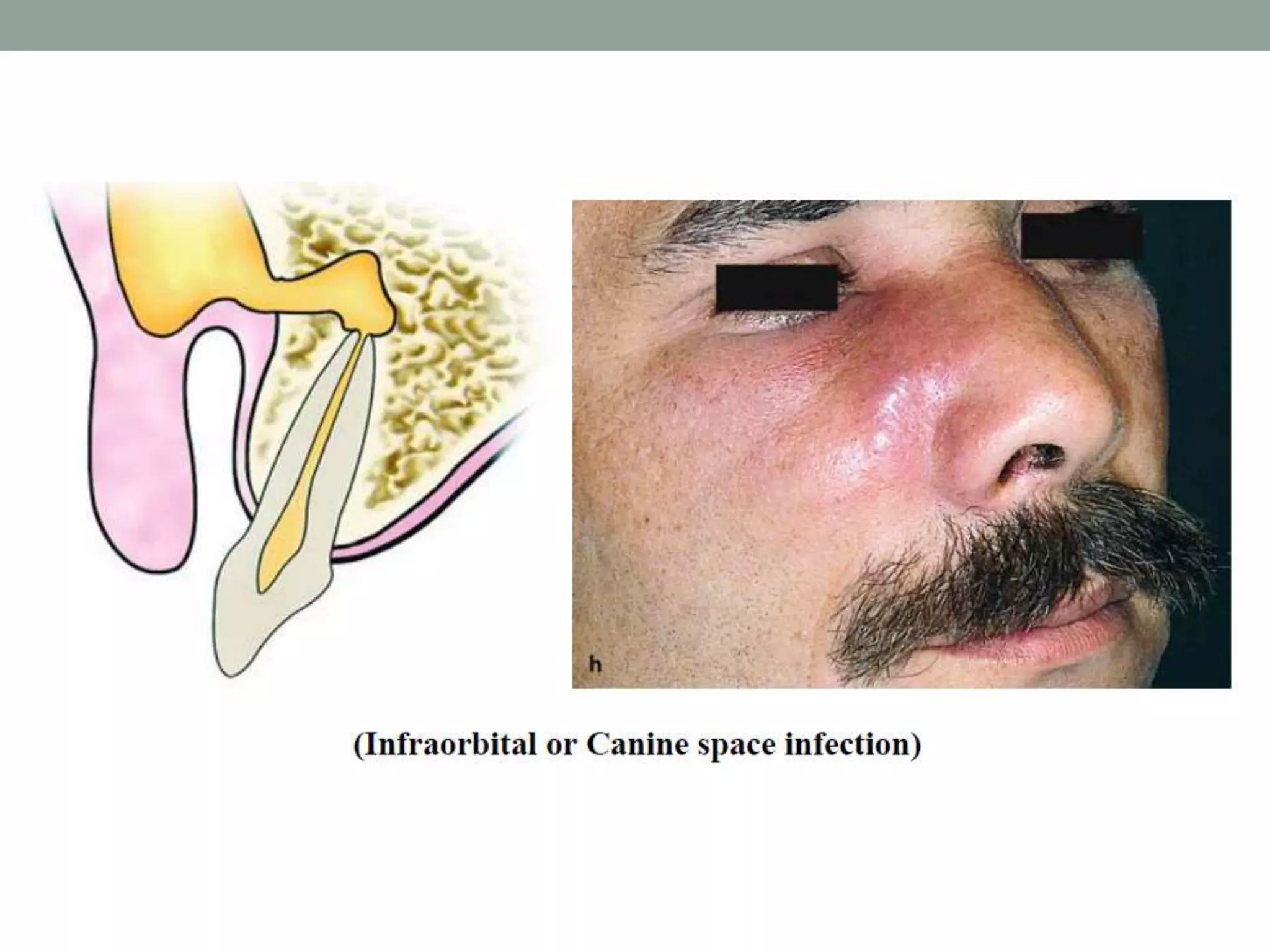 Fascial spaces.pptx | Ear, Nose and Throat Conditions | Diseases and ...