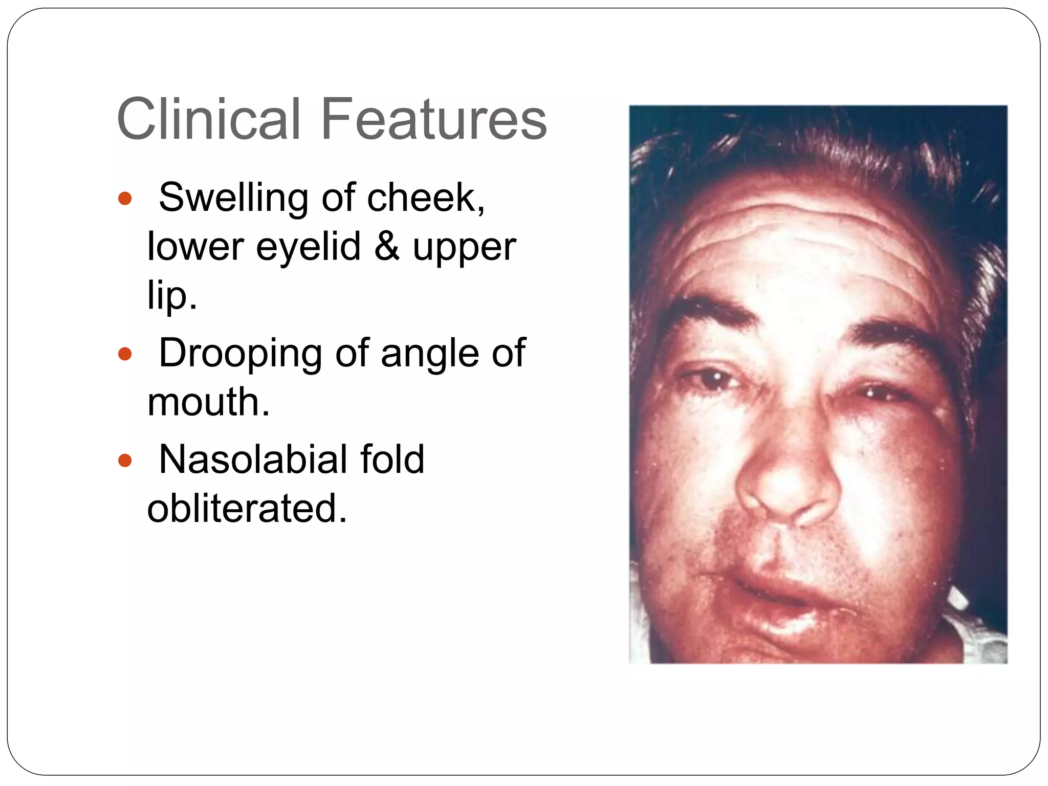 Fascial spaces of jaws and management | PPT