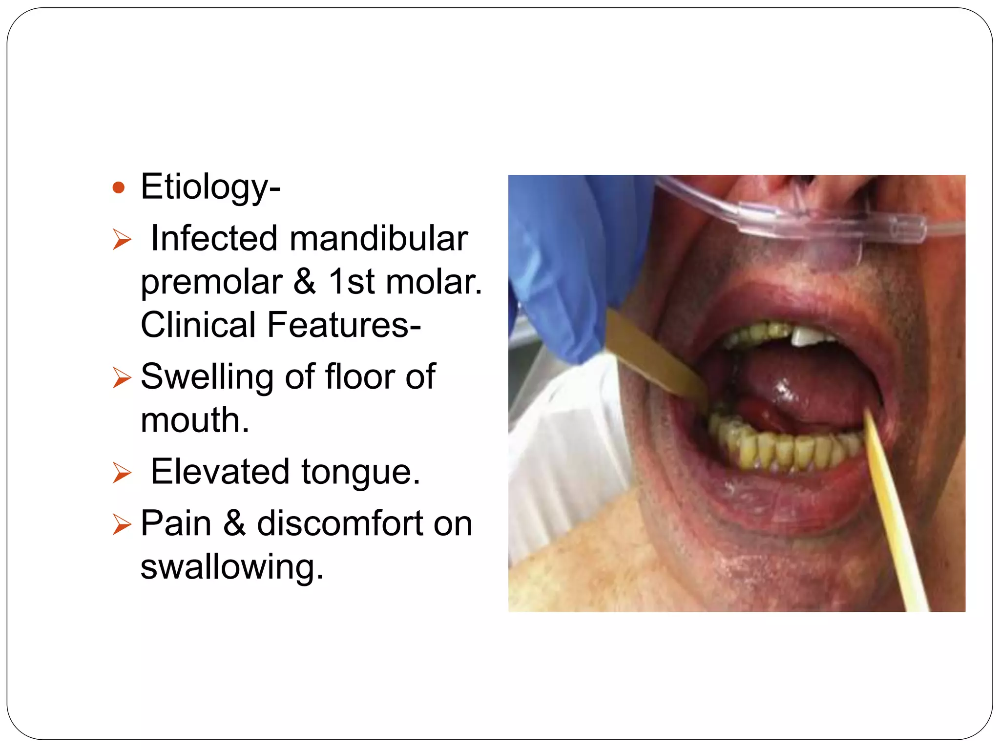 Fascial spaces of jaws and management | PPT
