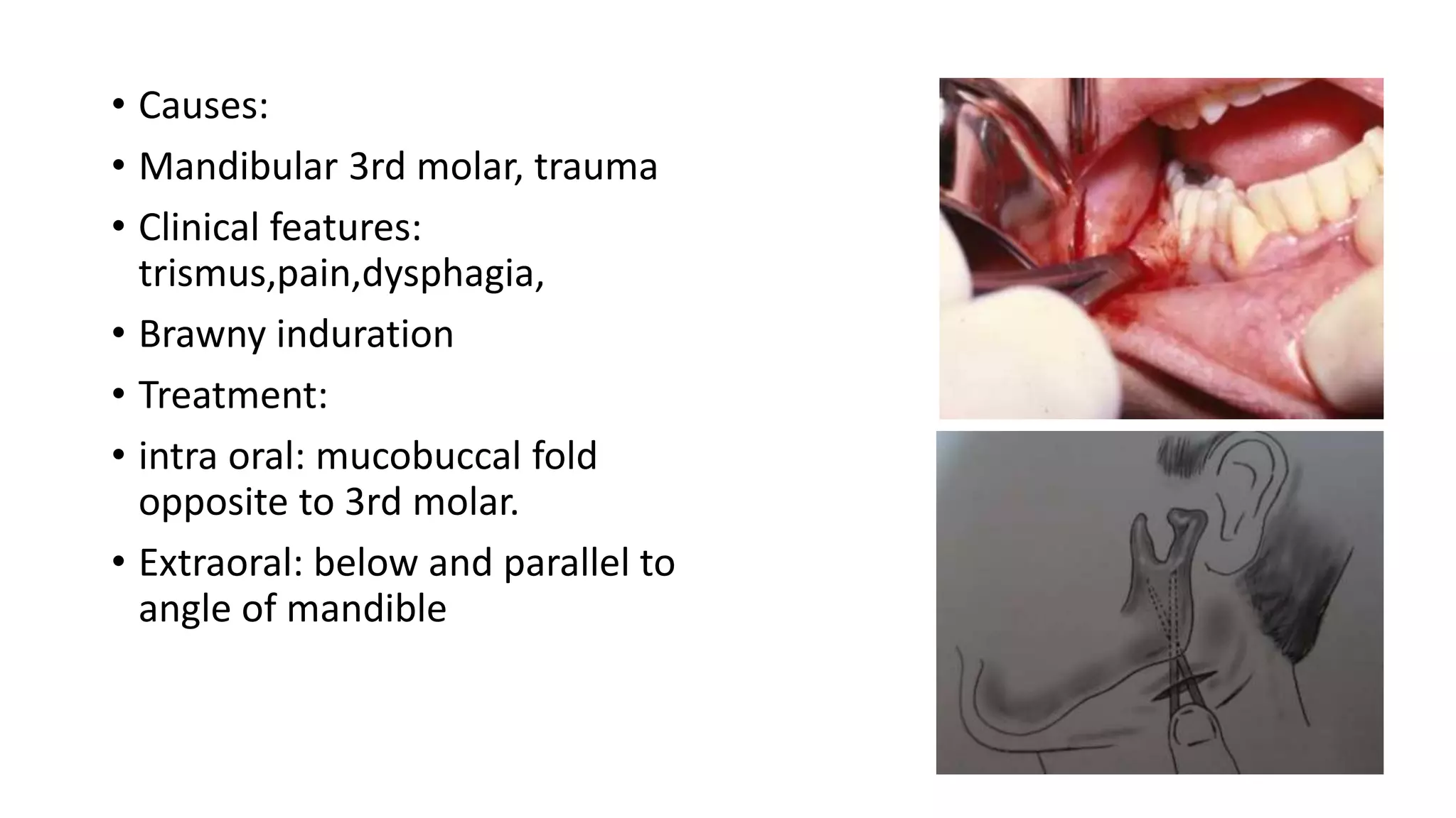 Fascial Spaces in the Head & Neck | PPTX