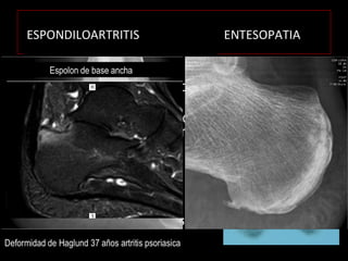 Fascia plantar | PPT