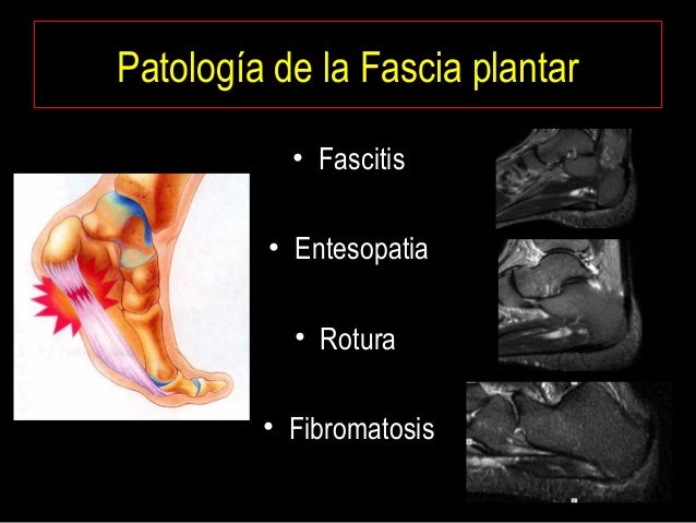 Fascia plantar