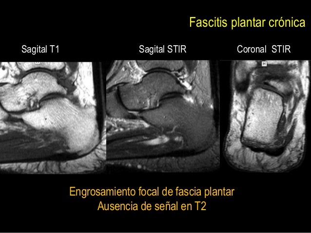 Fascia plantar